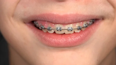 Children With Overbites Stock Footage ~ Royalty Free Stock Videos | Pond5