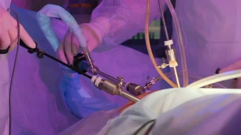 Laparoscopic Cholecystectomy Stock Videos – Royalty-Free HD & 4K Videos