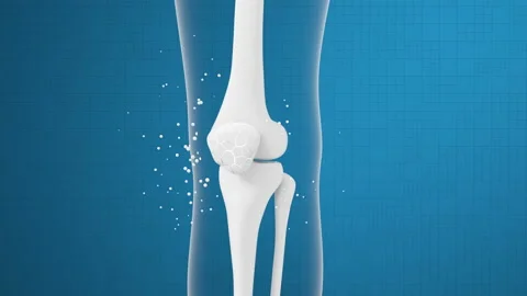 Leg bone and knee healing, 3d rendering. | Stock Video | Pond5