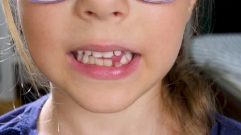 Little girl with wobbly tooth first milk... | Stock Video | Pond5