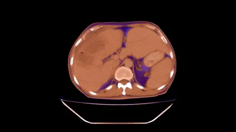 Liver abscess, CT scan | Stock Video | Pond5