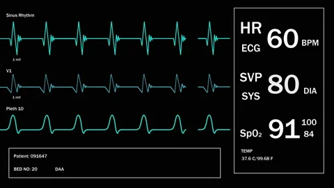 Looped: Patient monitor displays vital s... | Stock Video | Pond5