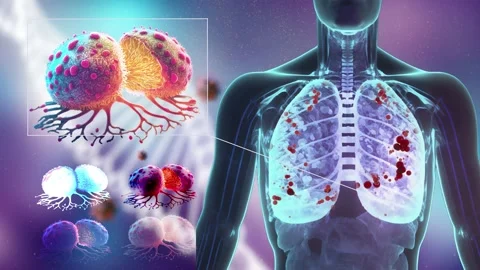 Lung Cancer concept with human body X-ra... | Stock Video | Pond5