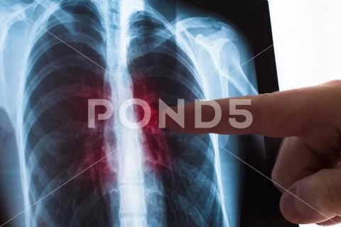 Photograph: Lung radiography concept. Radiology doctor examining at ...