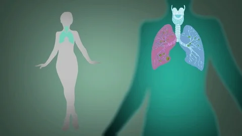 Lungs Infection Vector Animation g... | Stock Video | Pond5
