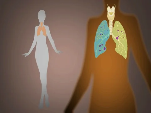 Lungs Infection Vector Animation o... | Stock Video | Pond5