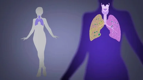 Lungs Infection Vector Animation p... | Stock Video | Pond5