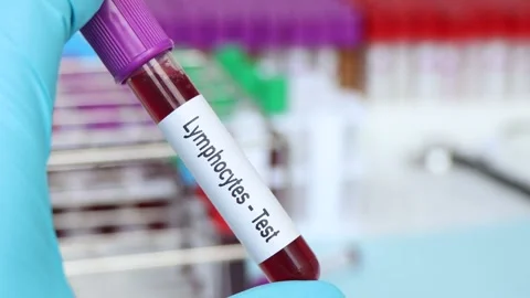 Lymphocytes test, blood sample to analyz... | Stock Video | Pond5
