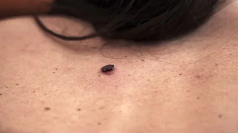 Macro shot of seborrheic keratosis on th... | Stock Video | Pond5