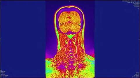 Magnetic resonance images of the brain a... | Stock Video | Pond5