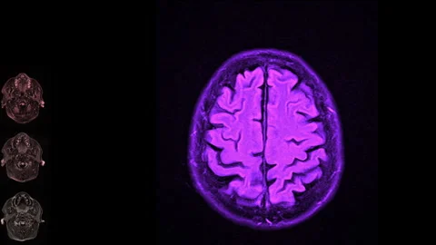 Magnetic resonance imaging of the brain.... | Stock Video | Pond5