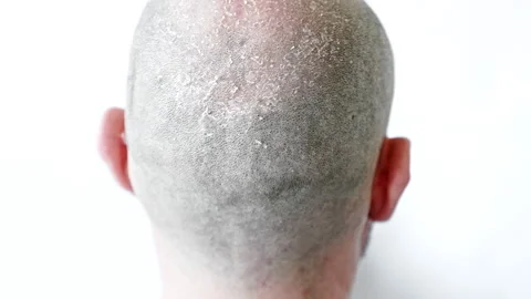 Male bald flaky head with dandruff and s... | Stock Video | Pond5