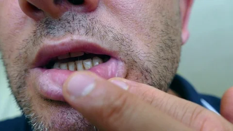 man with aphthae on lip. thrush, canker ... | Stock Video | Pond5