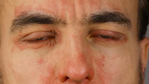 Psoriasis Dermatology Stock Videos – Royalty-Free HD & 4K Videos