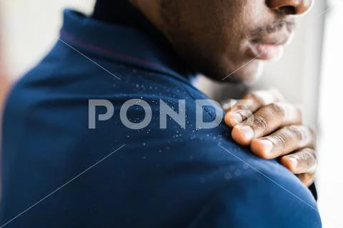 Man Brushing Dandruff From Dirty Suit. Itchy Head ~ Premium Photo ...