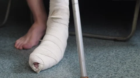 Broken Leg Cast Stock Video Footage | Royalty Free Broken Leg Cast ...