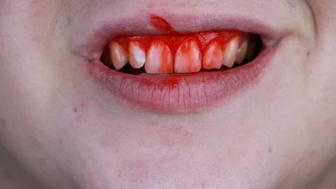 Nose Bleeding Stock Footage ~ Royalty Free Stock Videos | Pond5