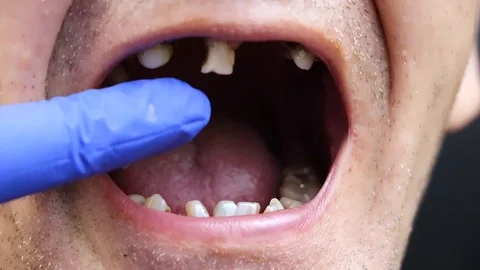 The man has rotten teeth, teeth fell out... | Stock Video | Pond5