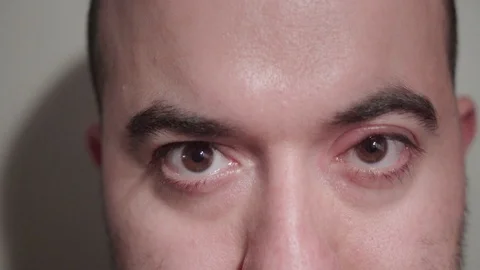 Man with Infected Swollen Eye Looking at... | Stock Video | Pond5