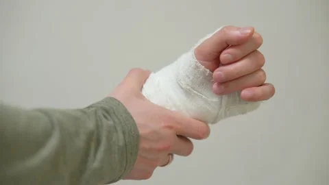 Man with plaster cast on arm. A broken a... | Stock Video | Pond5