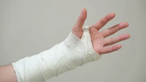 Man with plaster cast on arm. A broken a... | Stock Video | Pond5