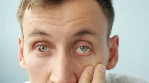man with red eyes raising eyelids with f... | Stock Video | Pond5
