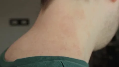 A man scratches the skin on his neck. Dr... | Stock Video | Pond5