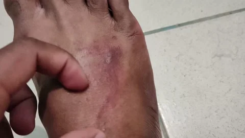 man scratching a red rash on the soles o... | Stock Video | Pond5