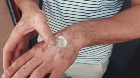 Man with skin problems on his hand massa... | Stock Video | Pond5