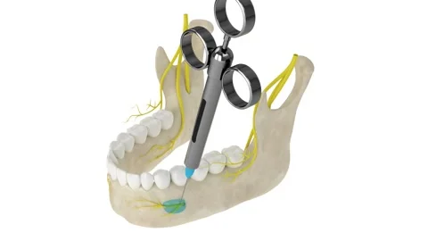Mandibular arch with incisive nerve bloc... | Stock Video | Pond5