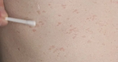 Man's hand smears areas of skin infected... | Stock Video | Pond5