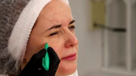 Marking the patient with a marker before... | Stock Video | Pond5