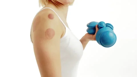 Marks On The Woman's Back From Acupunctu... | Stock Video | Pond5