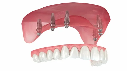 Maxillary prosthesis with gum All on 6 s... | Stock Video | Pond5