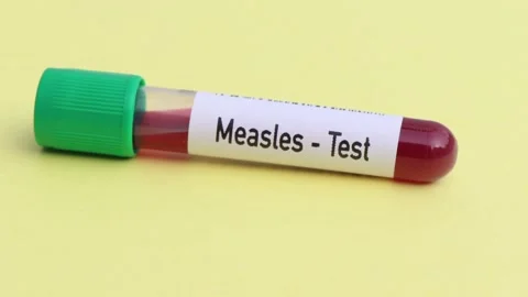 Measles test, blood sample to analyze in... | Stock Video | Pond5
