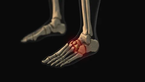Medical animation of the mid foot pain | Stock Video | Pond5