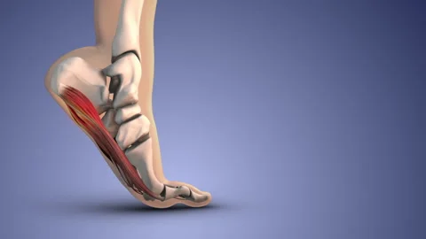 Medical animation of plantar fascia dysf... | Stock Video | Pond5