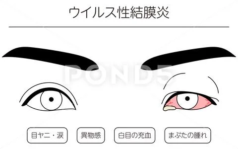 Medical Clipart, Line Drawing Illustration of Eye Disease and Viral ...