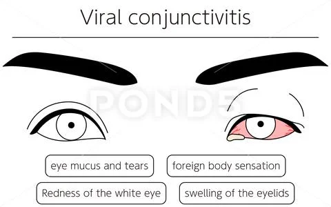 Medical Clipart, Line Drawing Illustration of Eye Disease and Viral ...