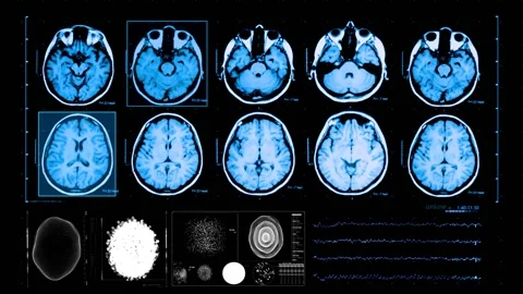 Medical Examination Head Mri Data Loop | Stock Video | Pond5