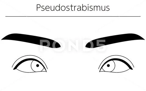 Medical illustrations, diagrammatic line drawings of eye diseases ...