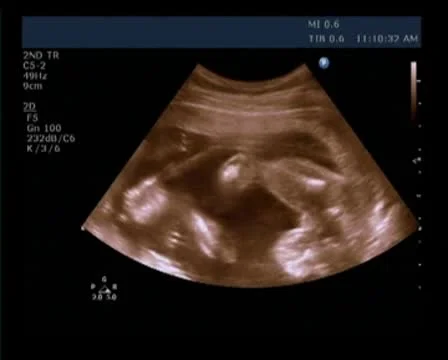 Medical ultrasound scan of human embryo | Stock Video | Pond5