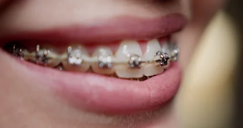 Metal brackets on teeth and importance o... | Stock Video | Pond5