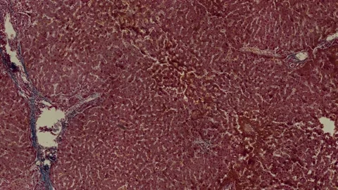 Micro shot of human liver Cirrhosis, und... | Stock Video | Pond5