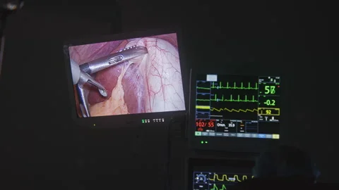 Monitor screen with view from laparoscop... | Stock Video | Pond5