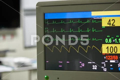 Monitoring graph displays of patient vital signs in operating room ...