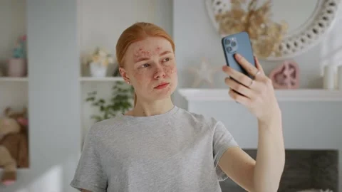 Teen Skin Acne Stock Videos – Royalty-Free HD & 4K Videos | Pond5