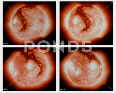 This montage is a sequence of soft x-ray photographs of the boot-shaped ...