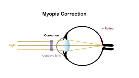 Myopia Diagram Stock Video Footage | Royalty Free Myopia Diagram Videos ...
