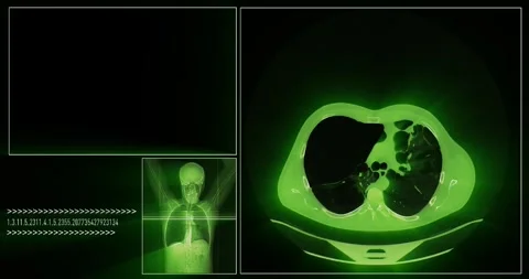 A Motion CT scan of emphysema in the rig... | Stock Video | Pond5